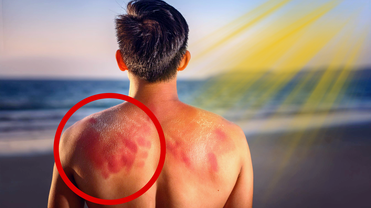 Trucos efectivos para aliviar las quemaduras del sol y cuidar tu piel