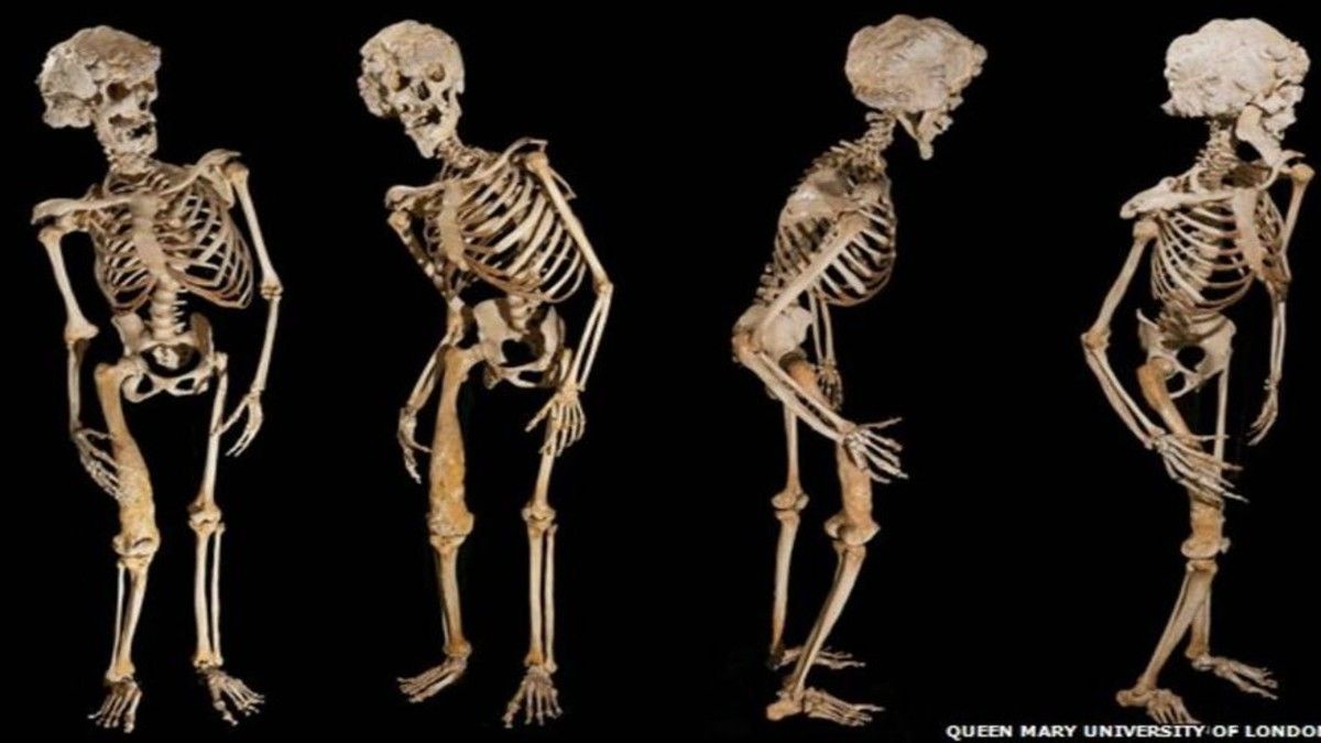 Lo apodaron el hombre elefante y vivió atormentado por su aspecto: la ...