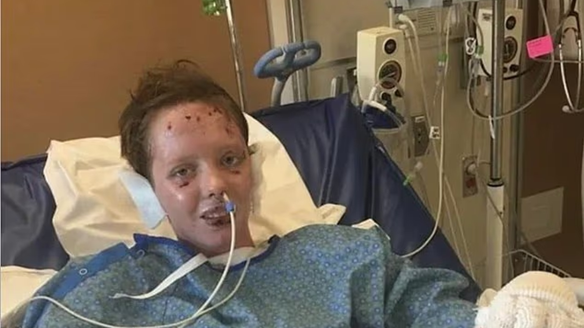 Se quemó el 40% de su cuerpo: renació y hoy Abigail comparte sus fotos ...