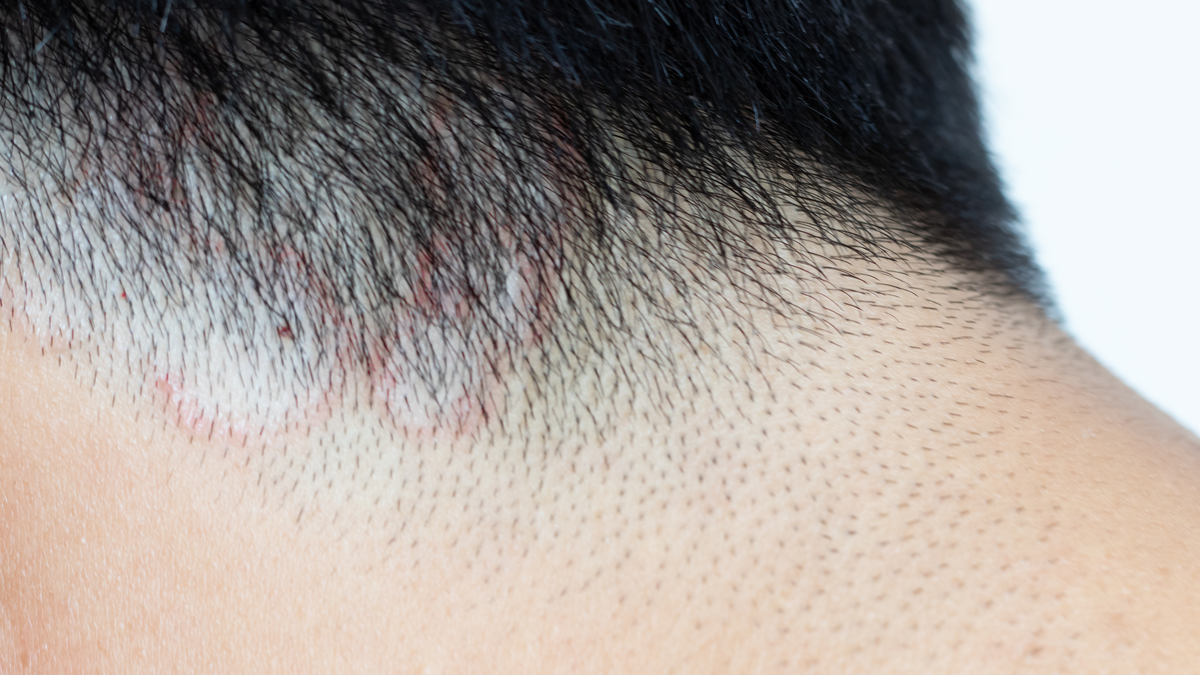 Cómo eliminar el hongo de la caspa para siempre