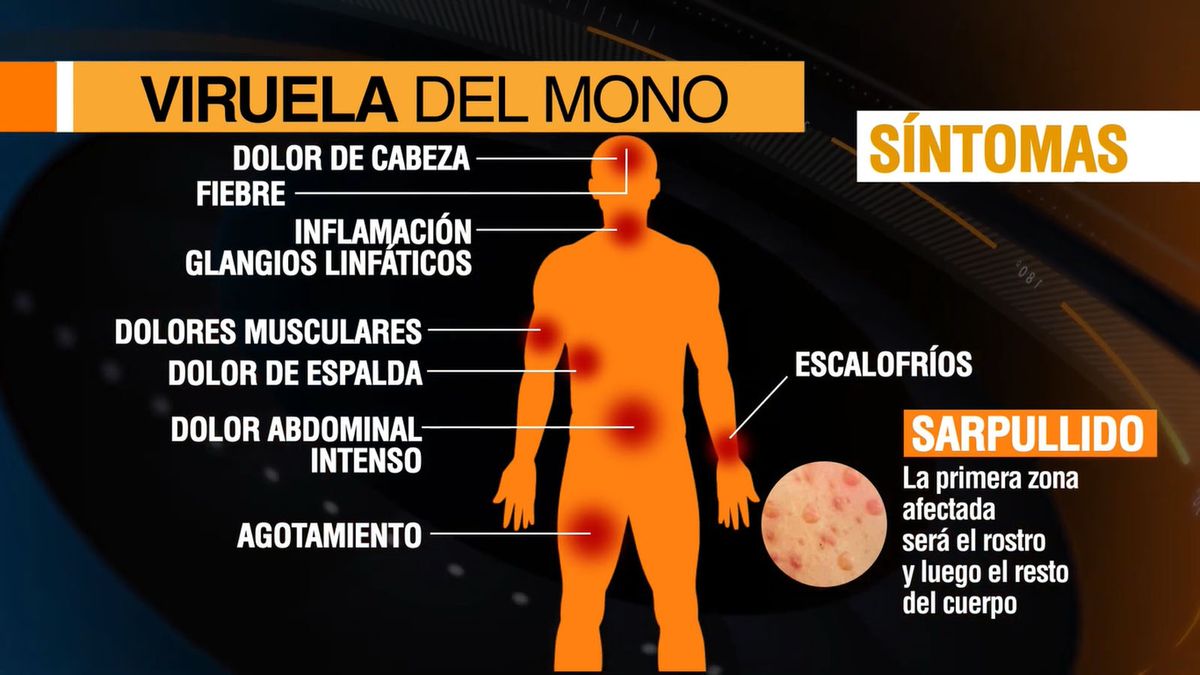 La viruela del mono desató una emergencia sanitaria mundial: cómo se contagia y cuál es el ...