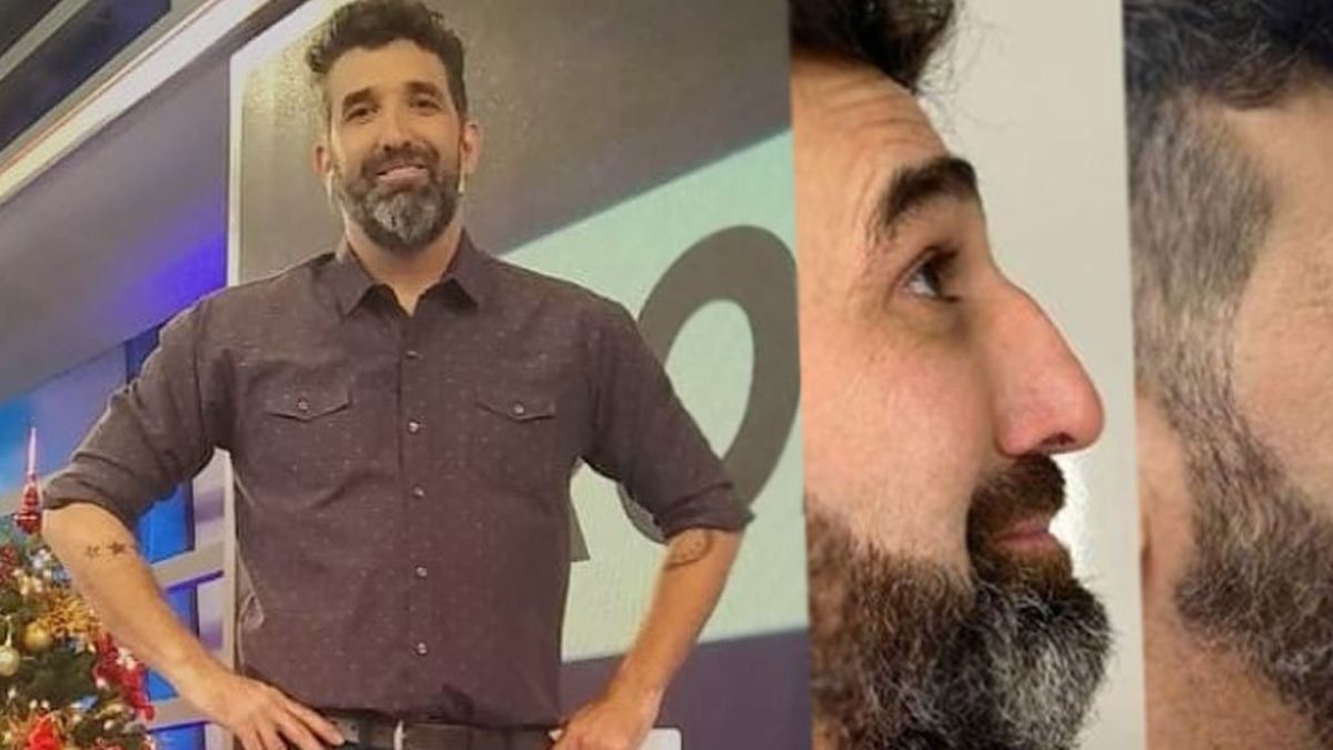 Diego Moranzoni se hizo una intervención en la nariz en vivo: soy otro
