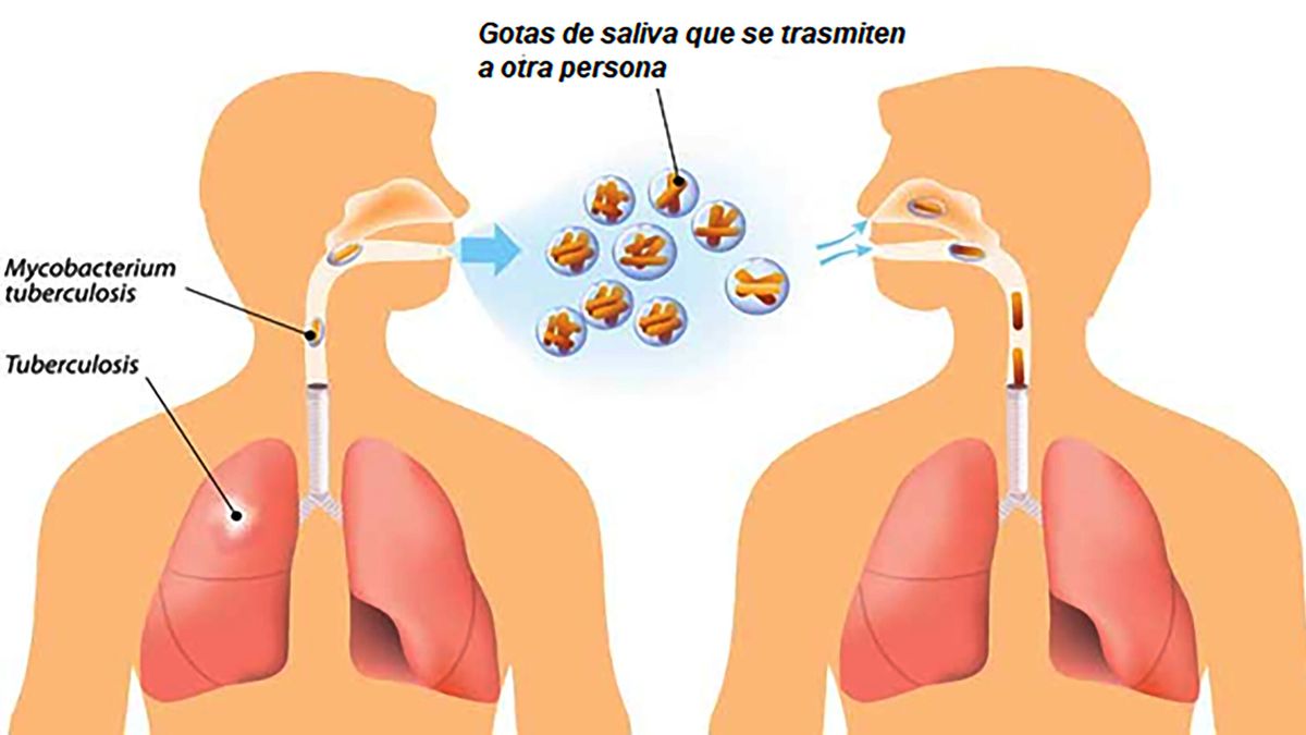 Alerta por la suba de casos de tuberculosis en Argentina: cómo se ...