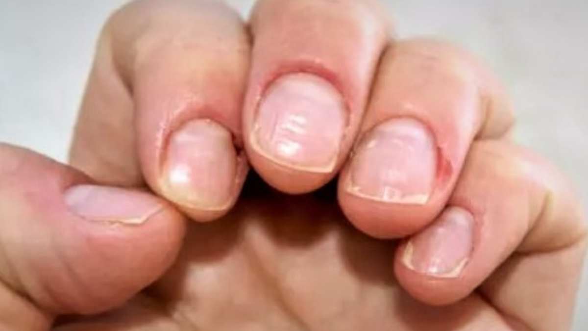 Que significa tener las uñas rayadas